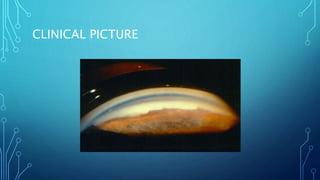 uveitic inflammatory glaucoma.pptx