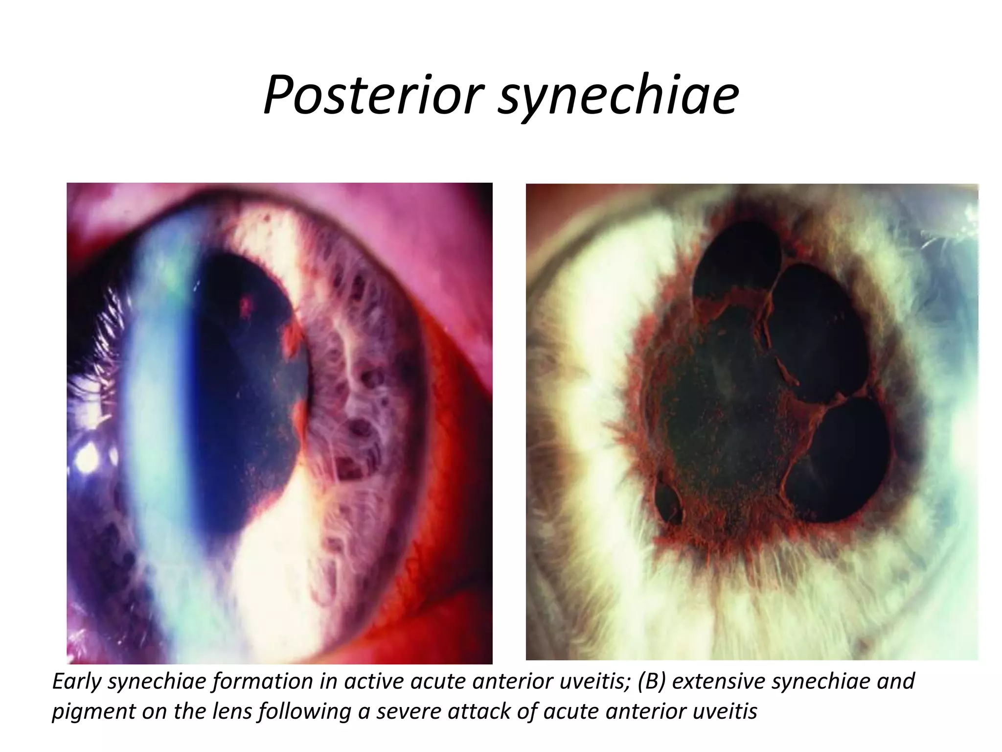 Uveitis investigations | PPTX