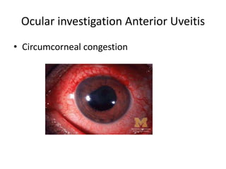 Uveitis investigations | PPTX