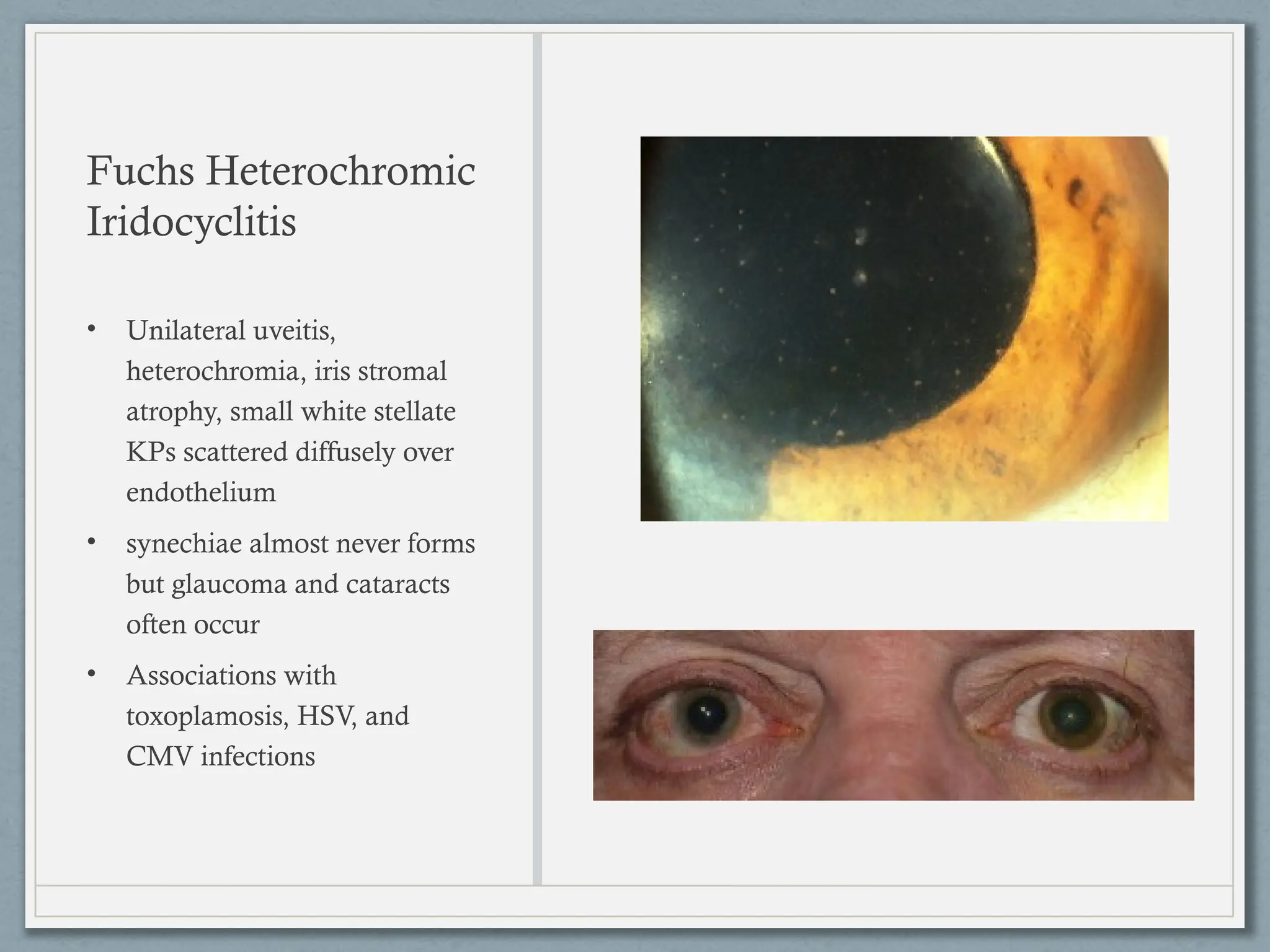 uveitis pptx medicine related condition | PPTX