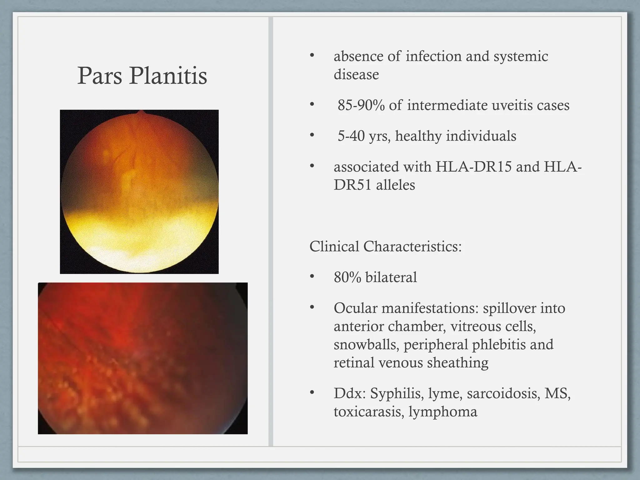 uveitis pptx medicine related condition | PPTX