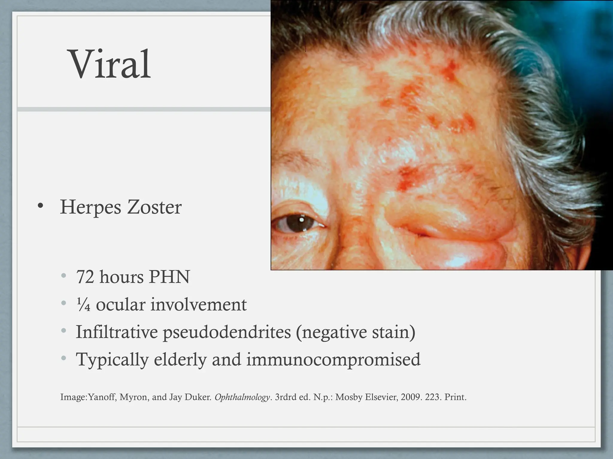 uveitis pptx medicine related condition | PPT