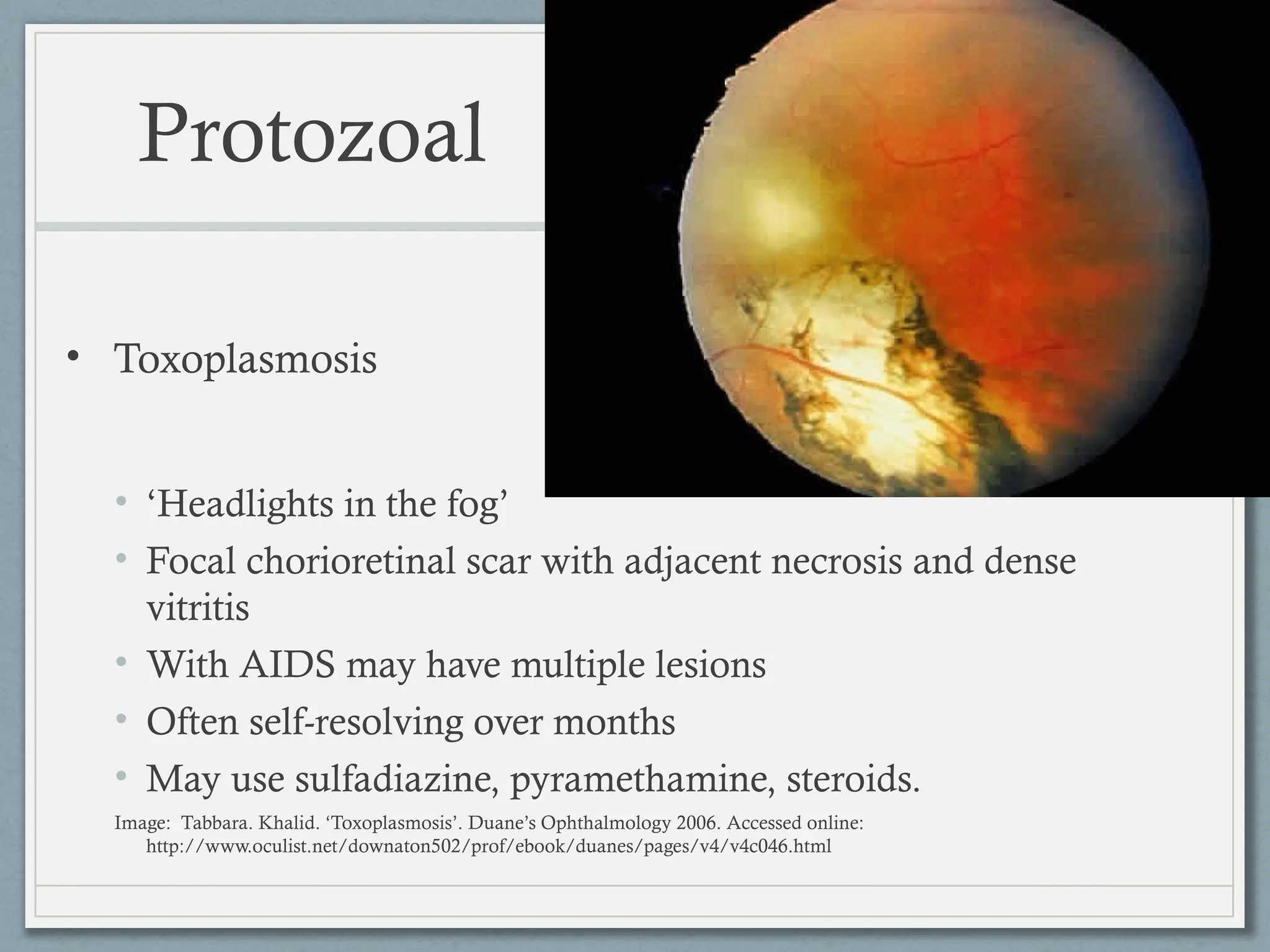 Uveitis Pptx Medicine Related Condition Ppt