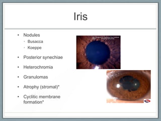 Uveitis | PPTX
