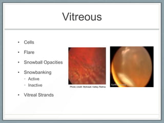 Uveitis | PPTX