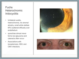 Uveitis | PPTX