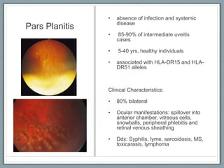 Uveitis | PPTX