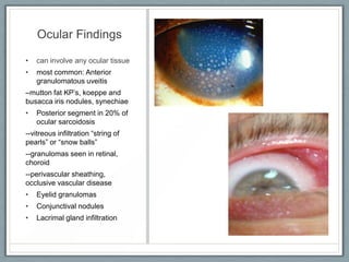 Uveitis | PPTX