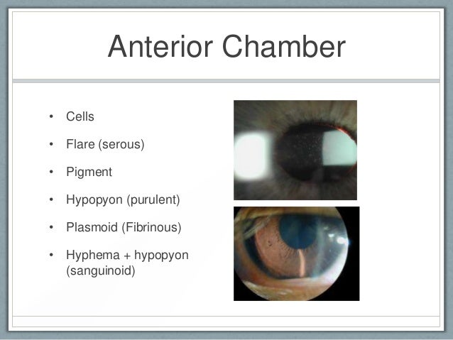 Uveitis
