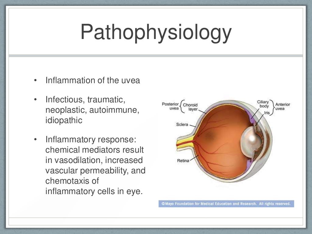 Uveitis