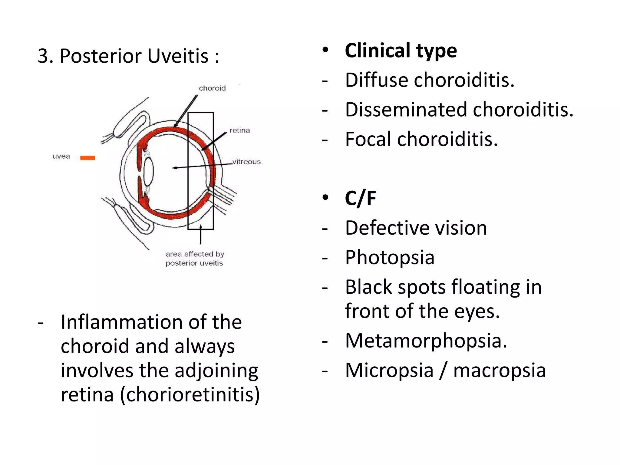 Uveitis | PPTX