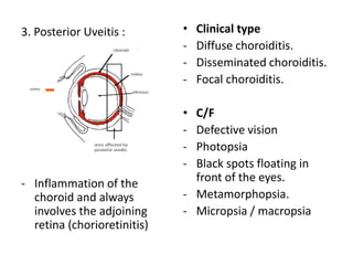 Uveitis | PPT