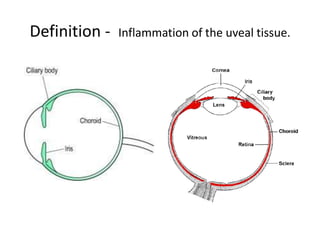 Uveitis | PPTX