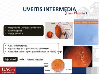 Uveitis | PPTX