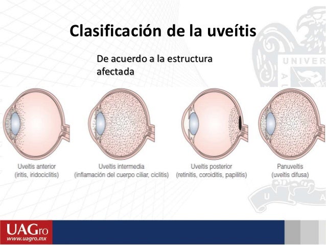 Uveitis