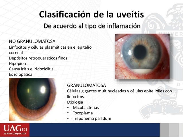 Uveitis