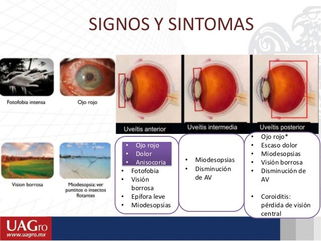Uveitis