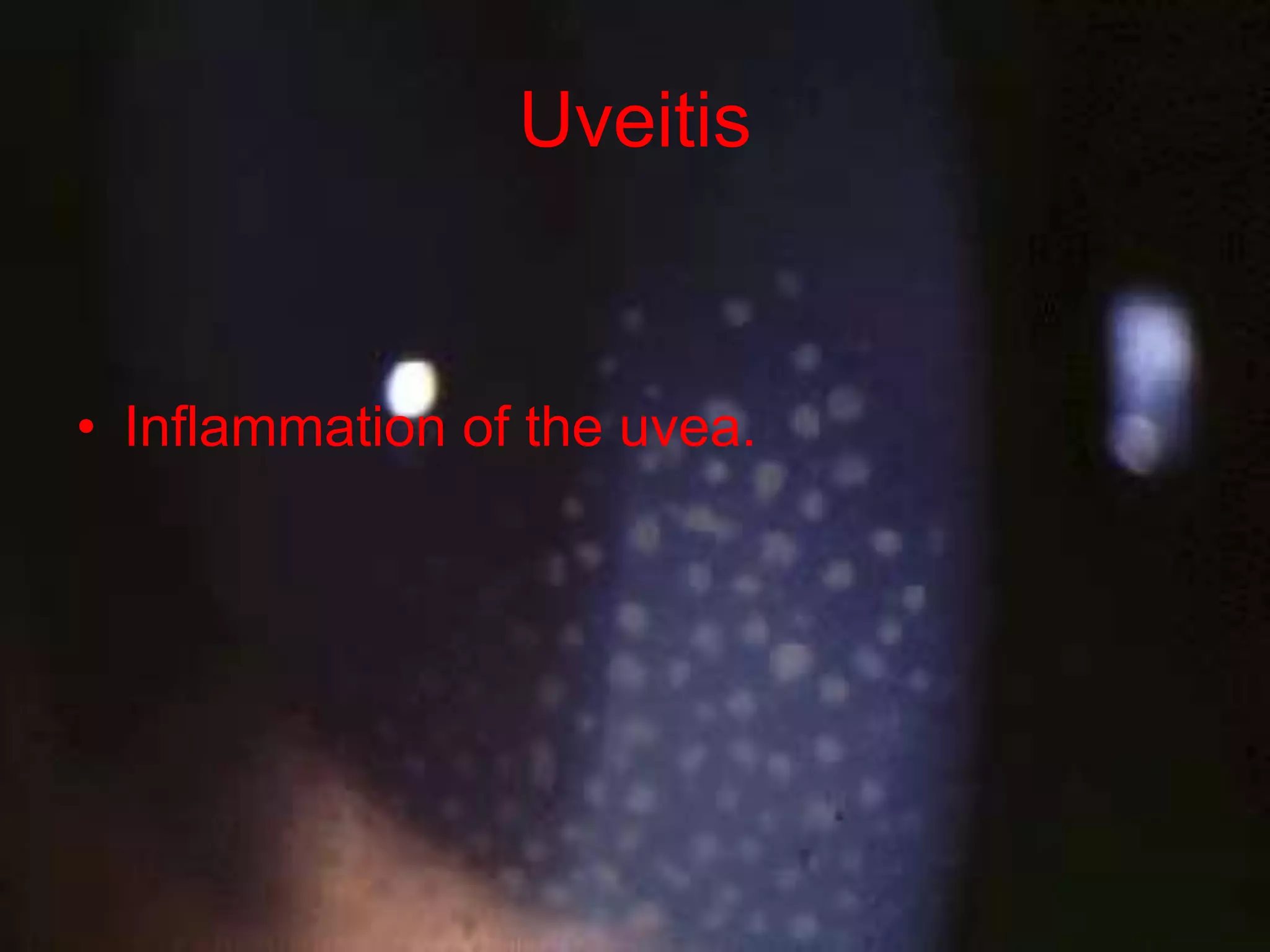 Uveitis | PPTX | Eye and Vision Conditions | Diseases and Conditions
