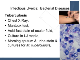 Uveitis | PPTX
