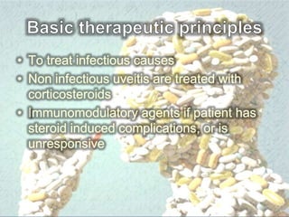 Uveitis | PPTX