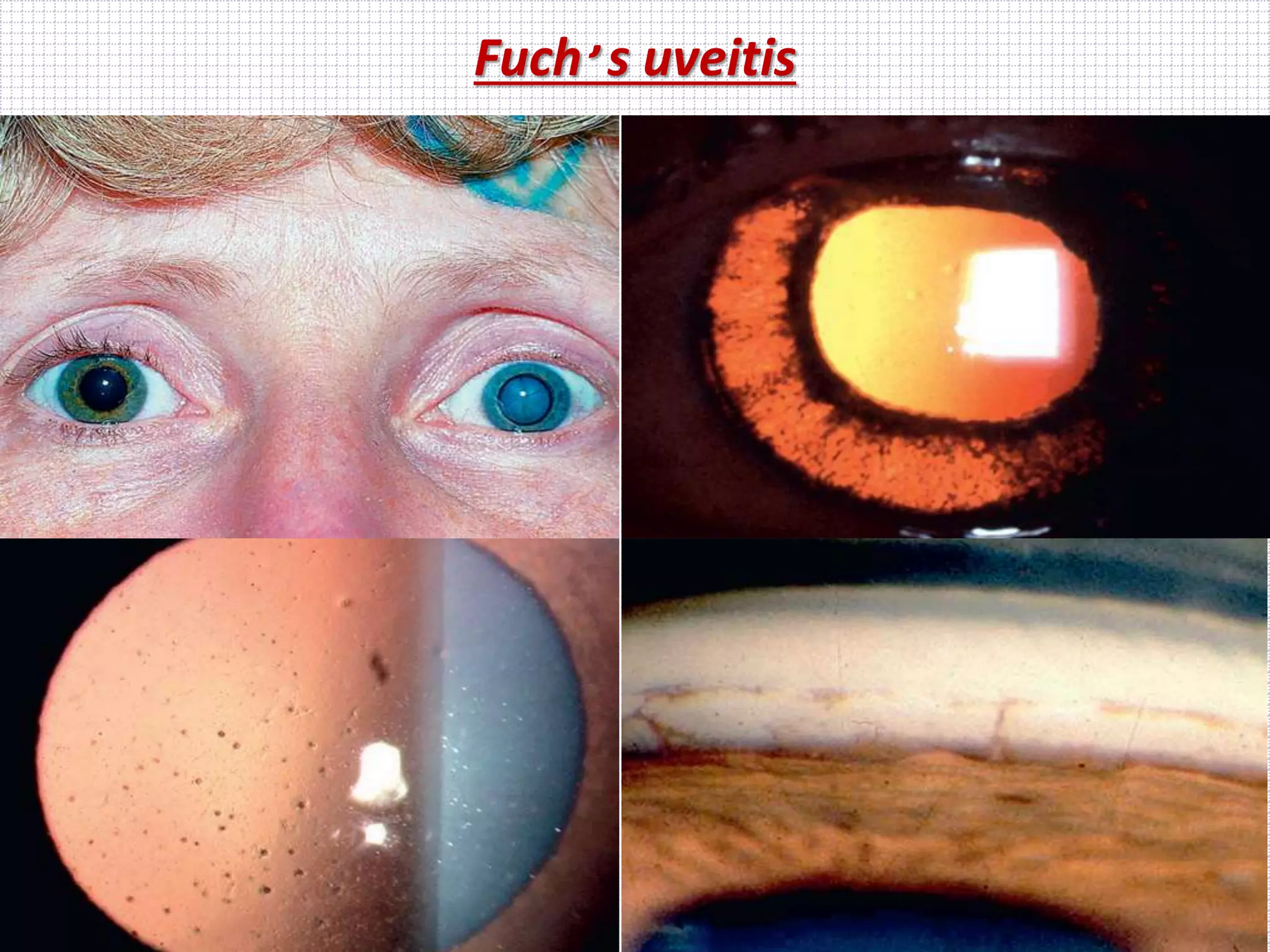 Uveitis | PPTX | Eye and Vision Conditions | Diseases and Conditions