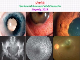 Uveitis | PPT