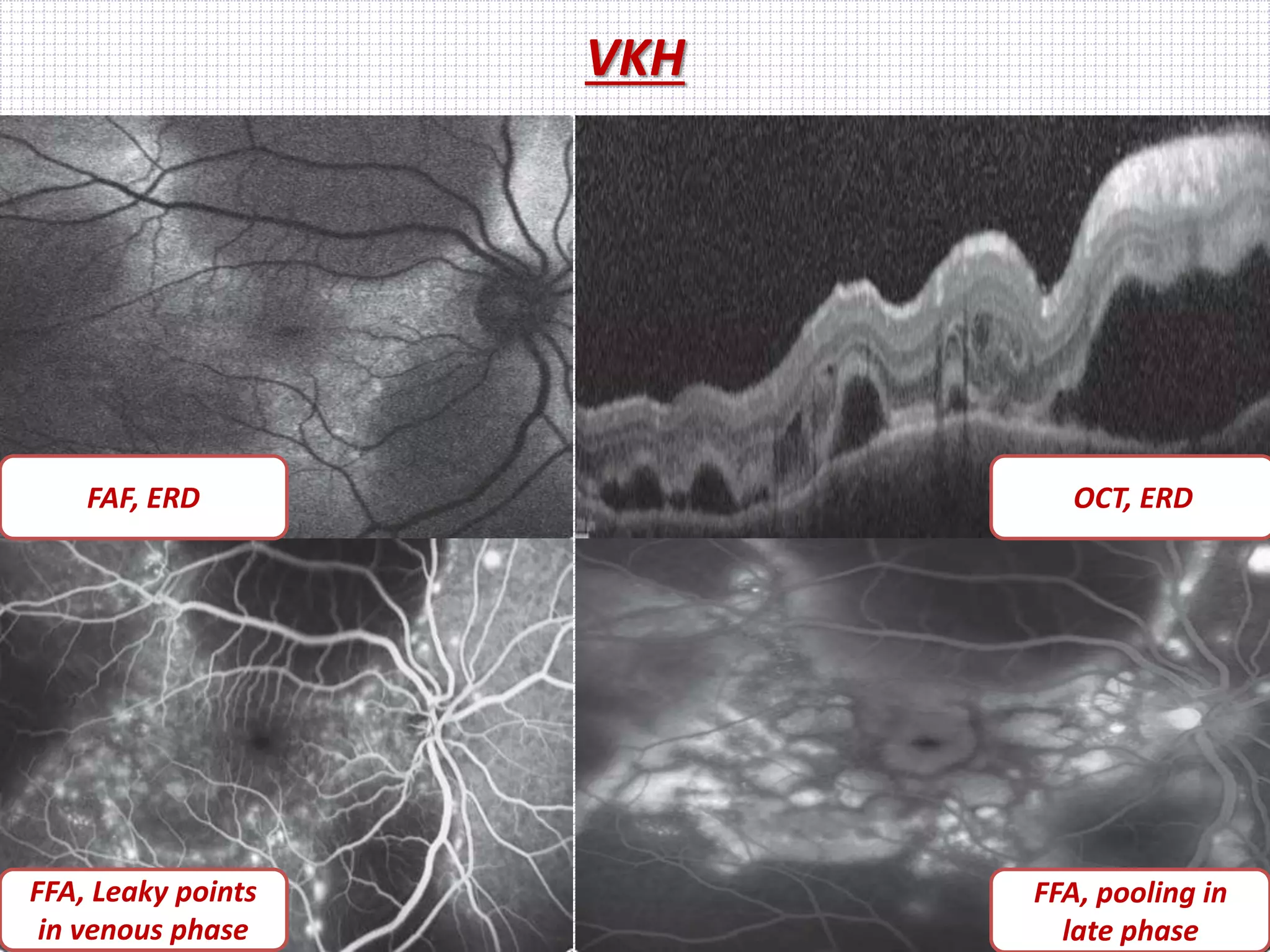 Uveitis (recent) | PPT