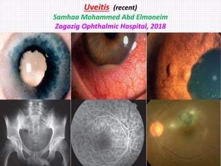 Uveitis (recent) | PPTX