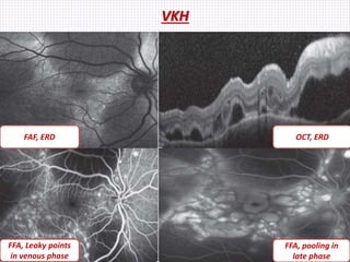 Uveitis (recent) | PPTX