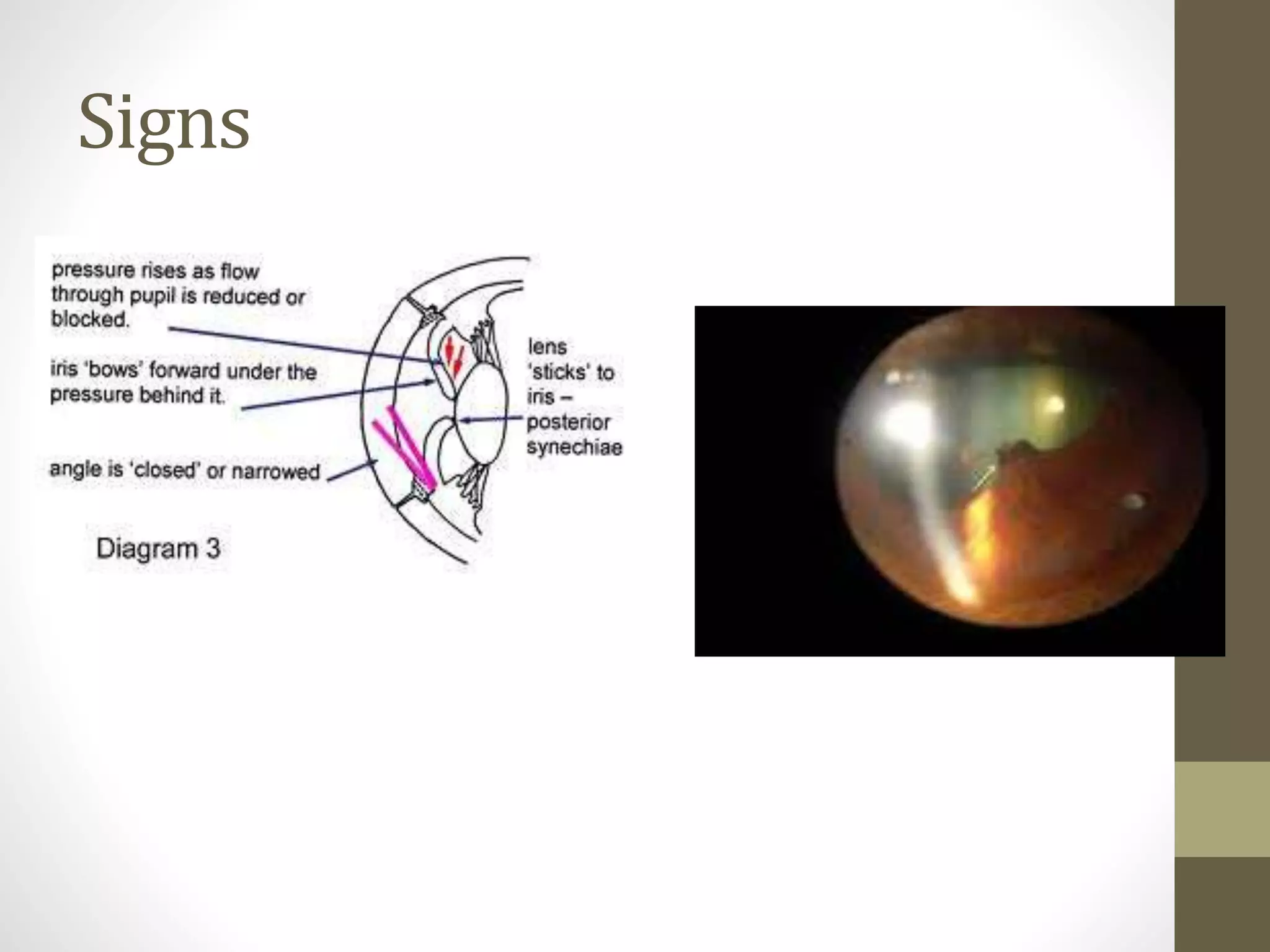 Uveitis | PPTX