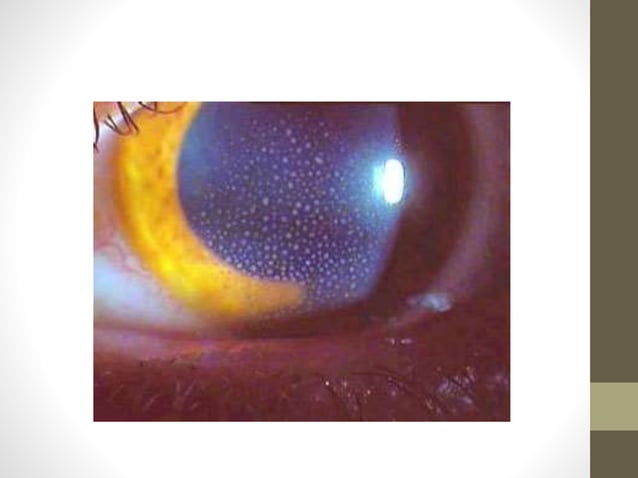 Uveitis | PPTX