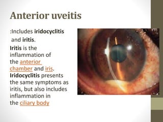 Uveitis | PPTX