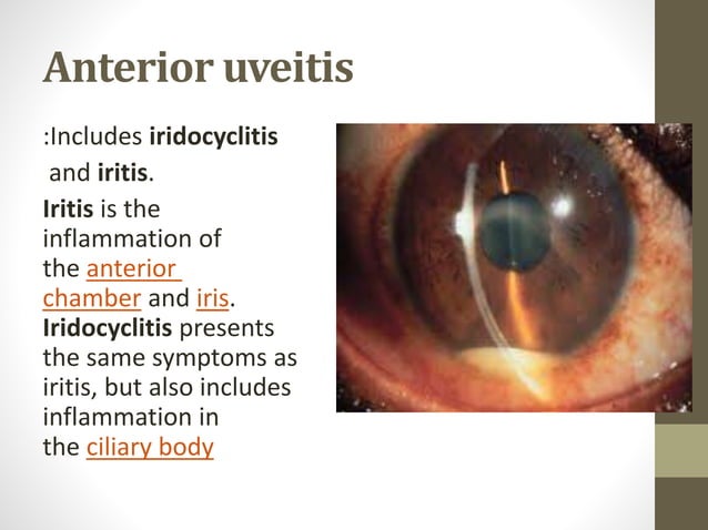 Uveitis | PPTX
