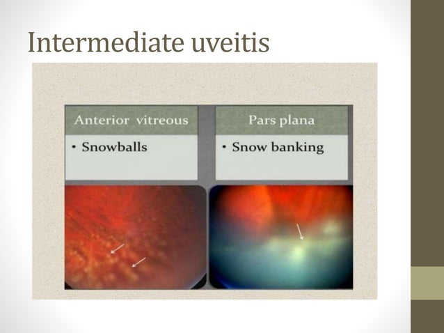 Uveitis | PPTX