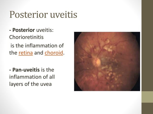 Uveitis | PPTX