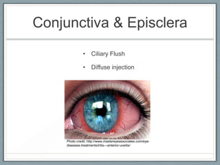 Ciliary Flush Vs Conjunctivitis