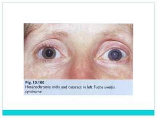 Uveitis | PPTX