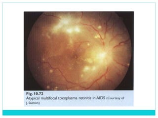 Uveitis | PPTX