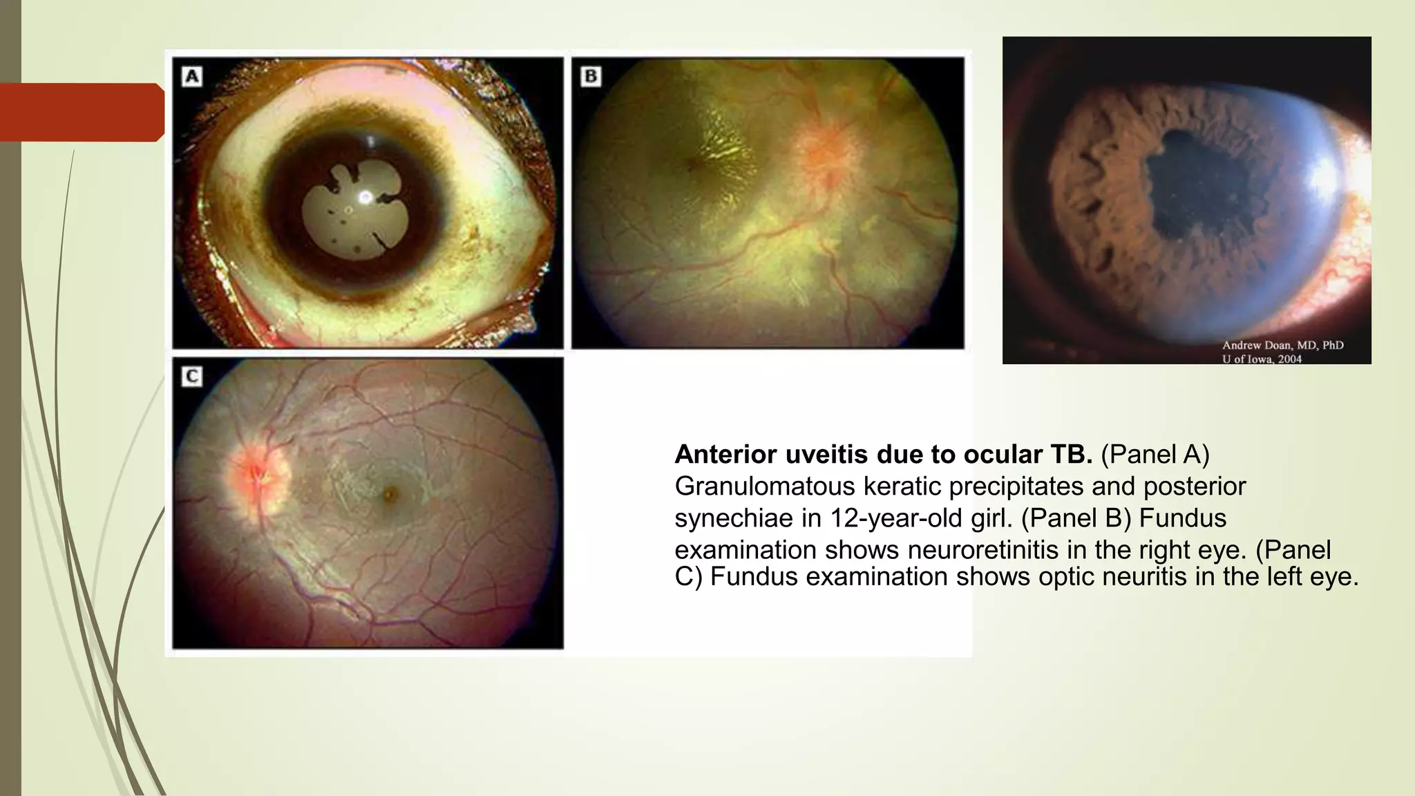 Tubercular Intermediate Uveitis | PPT