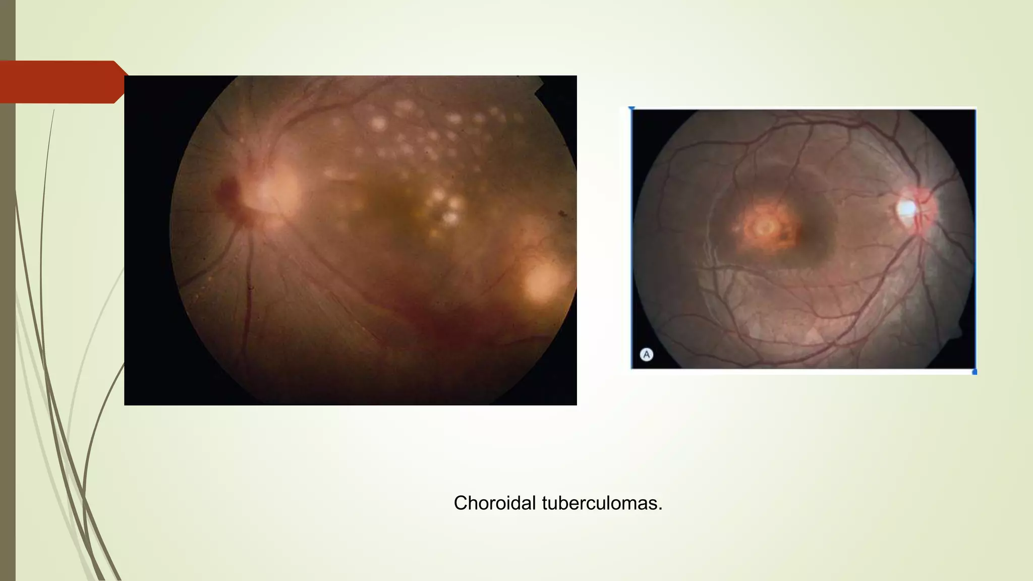 Tubercular Intermediate Uveitis | PPT