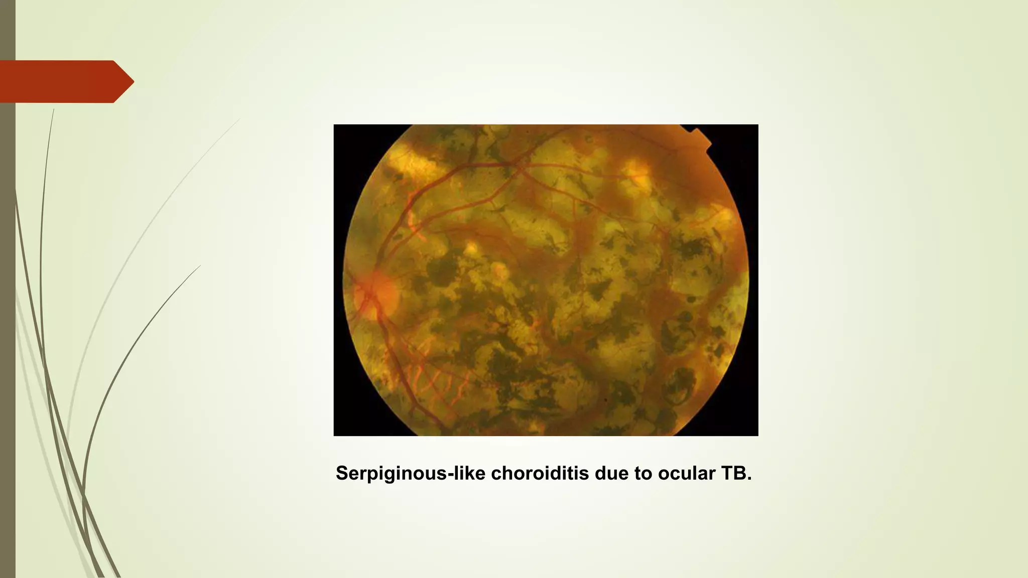Tubercular Intermediate Uveitis | PPT
