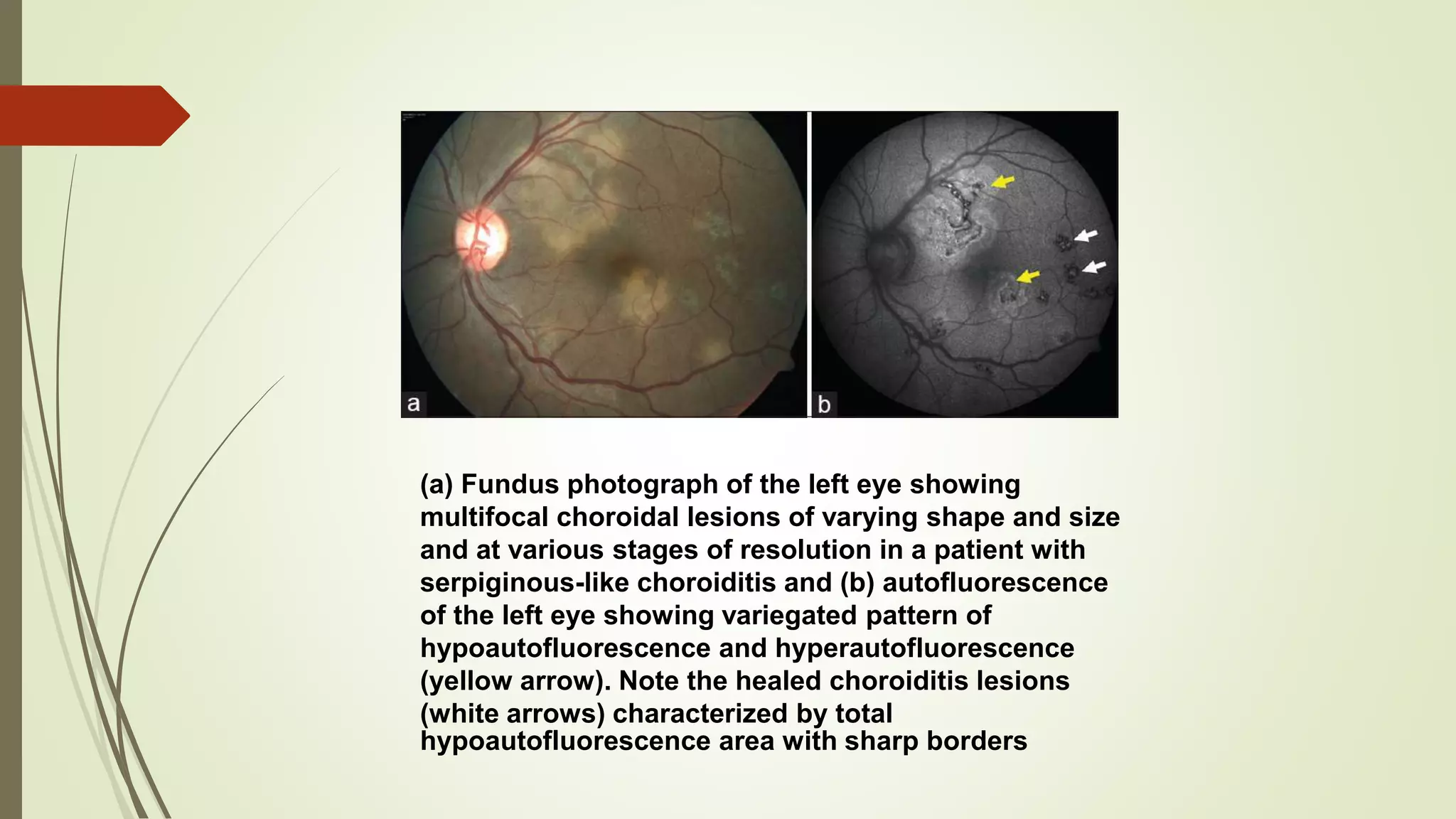 Tubercular Intermediate Uveitis | PPT