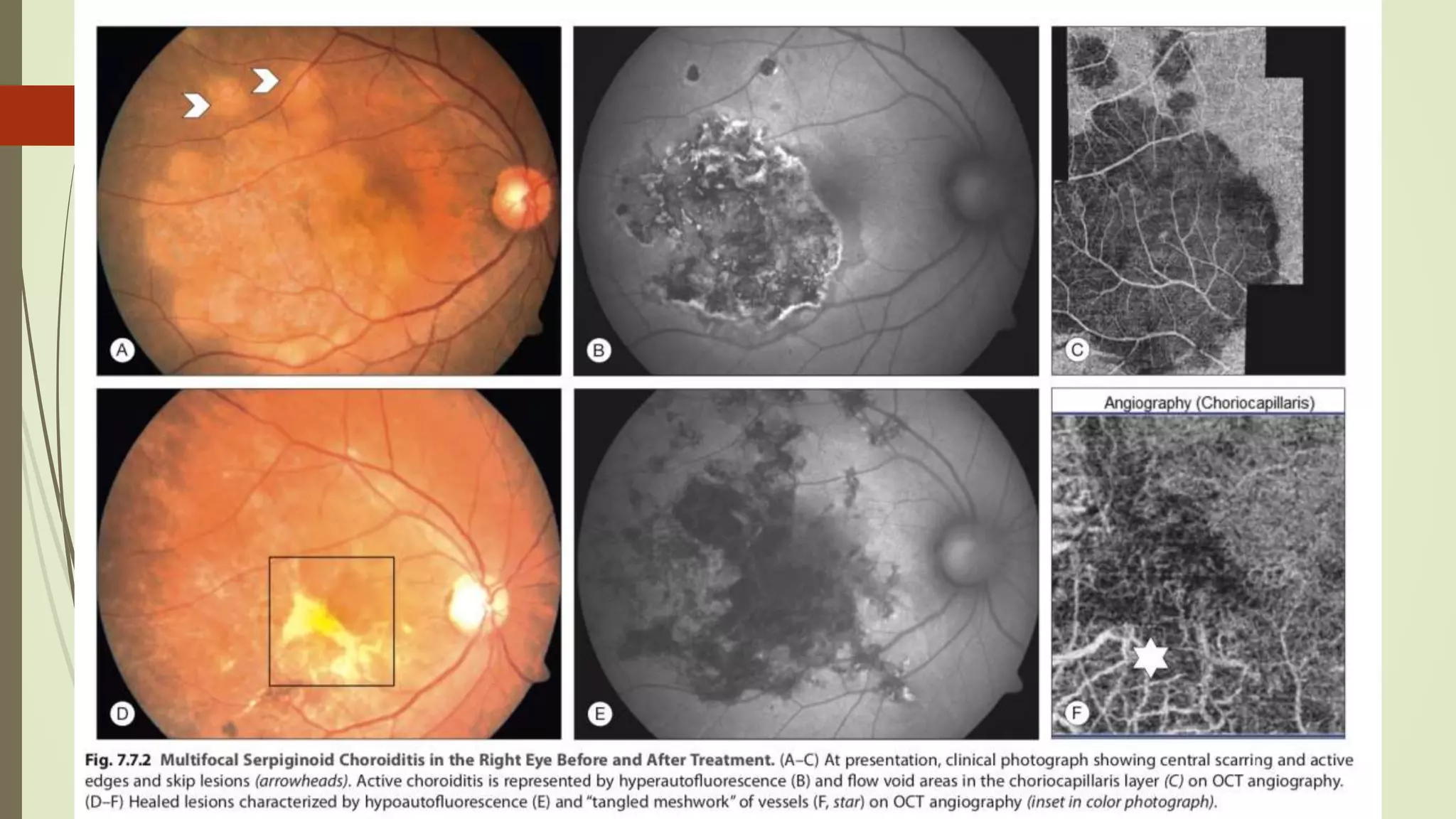 Tubercular Intermediate Uveitis | PPT