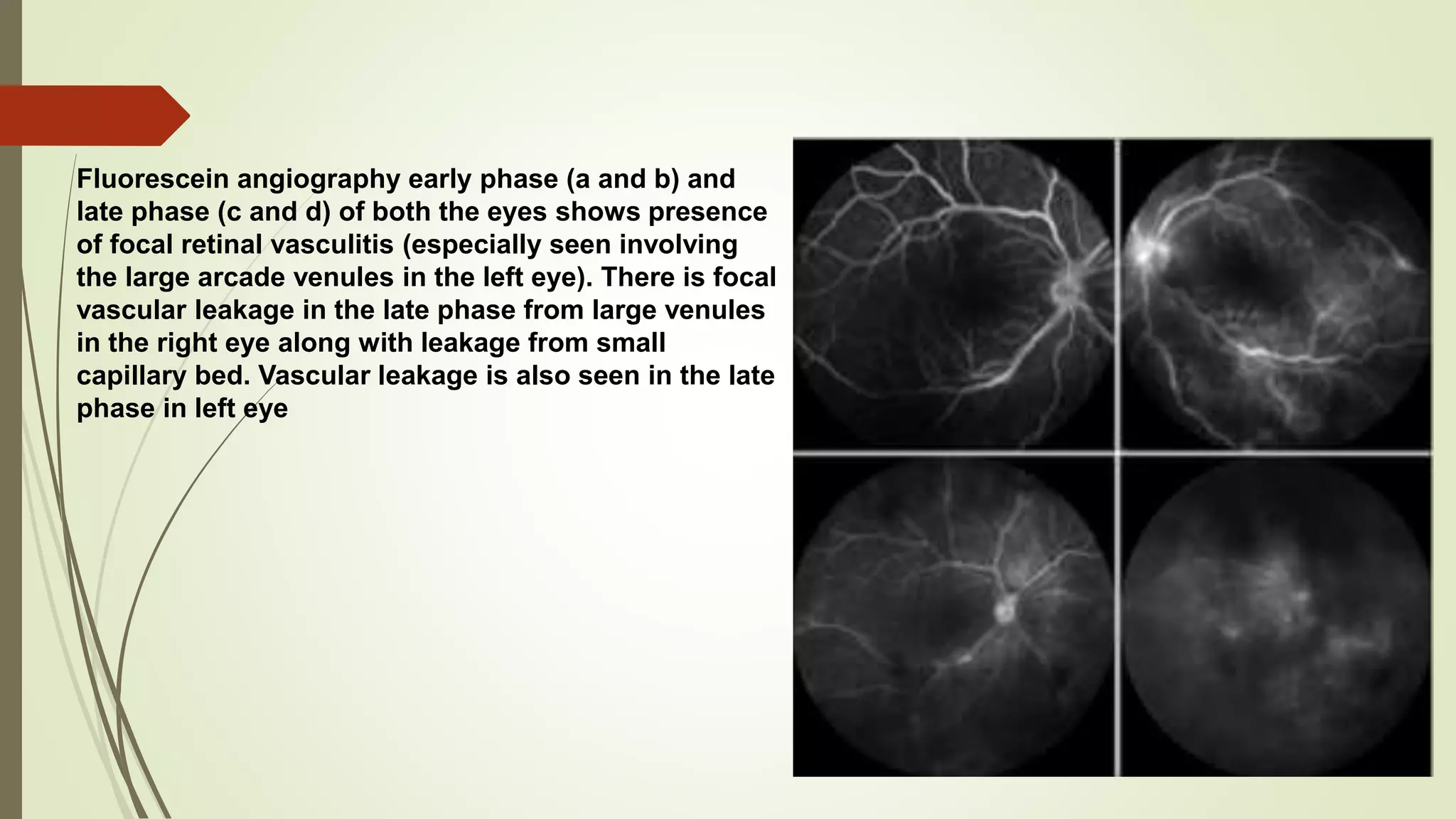 Tubercular Intermediate Uveitis | PPT