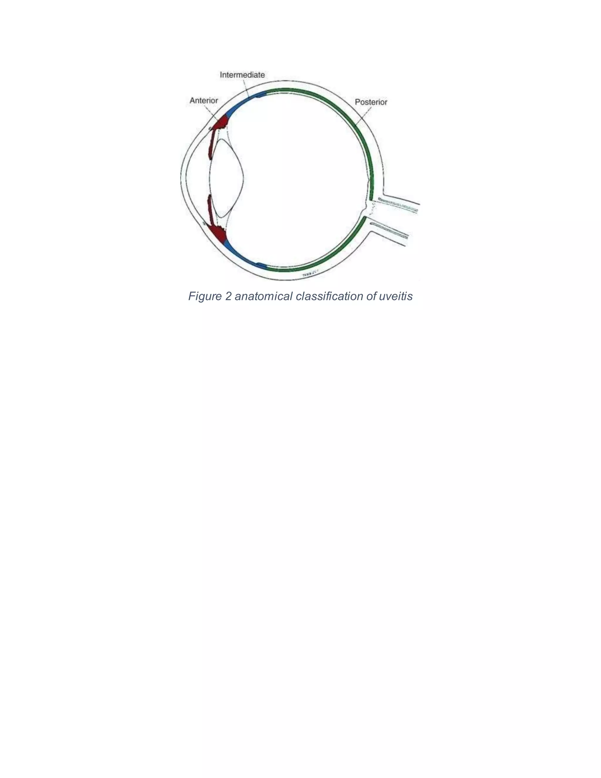 Uveitis (Classification, Panuveitis, Endophthalmitis, Panophthalmitis ...