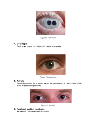 Uveitis (Classification, Panuveitis, Endophthalmitis, Panophthalmitis ...