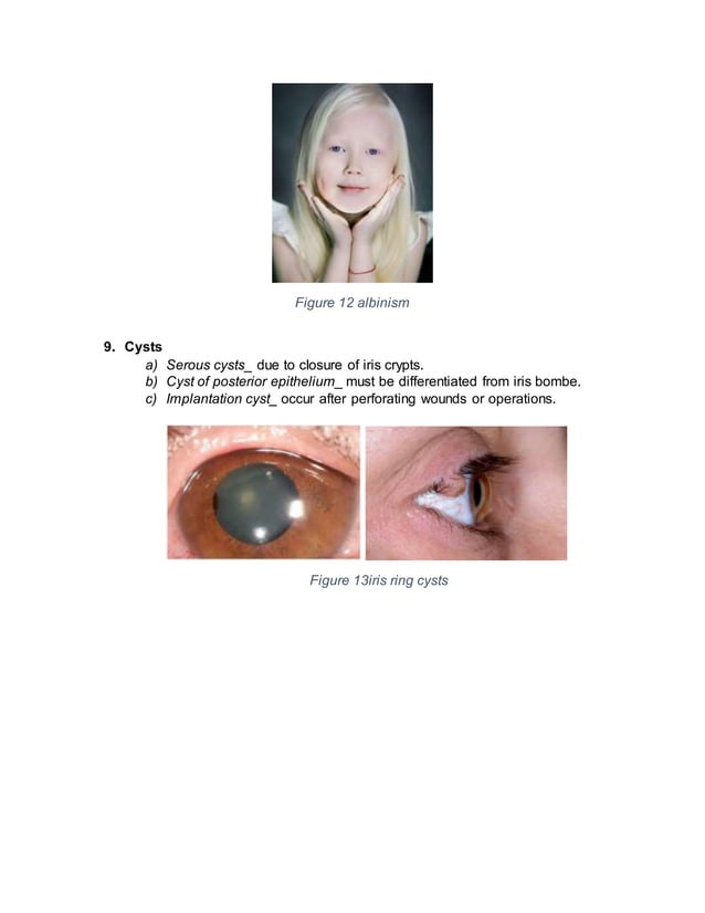 Uveitis (Classification, Panuveitis, Endophthalmitis, Panophthalmitis ...