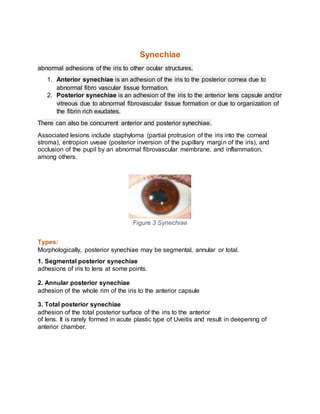 Uveitis (Classification, Panuveitis, Endophthalmitis, Panophthalmitis ...