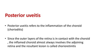 uveitis.pptx