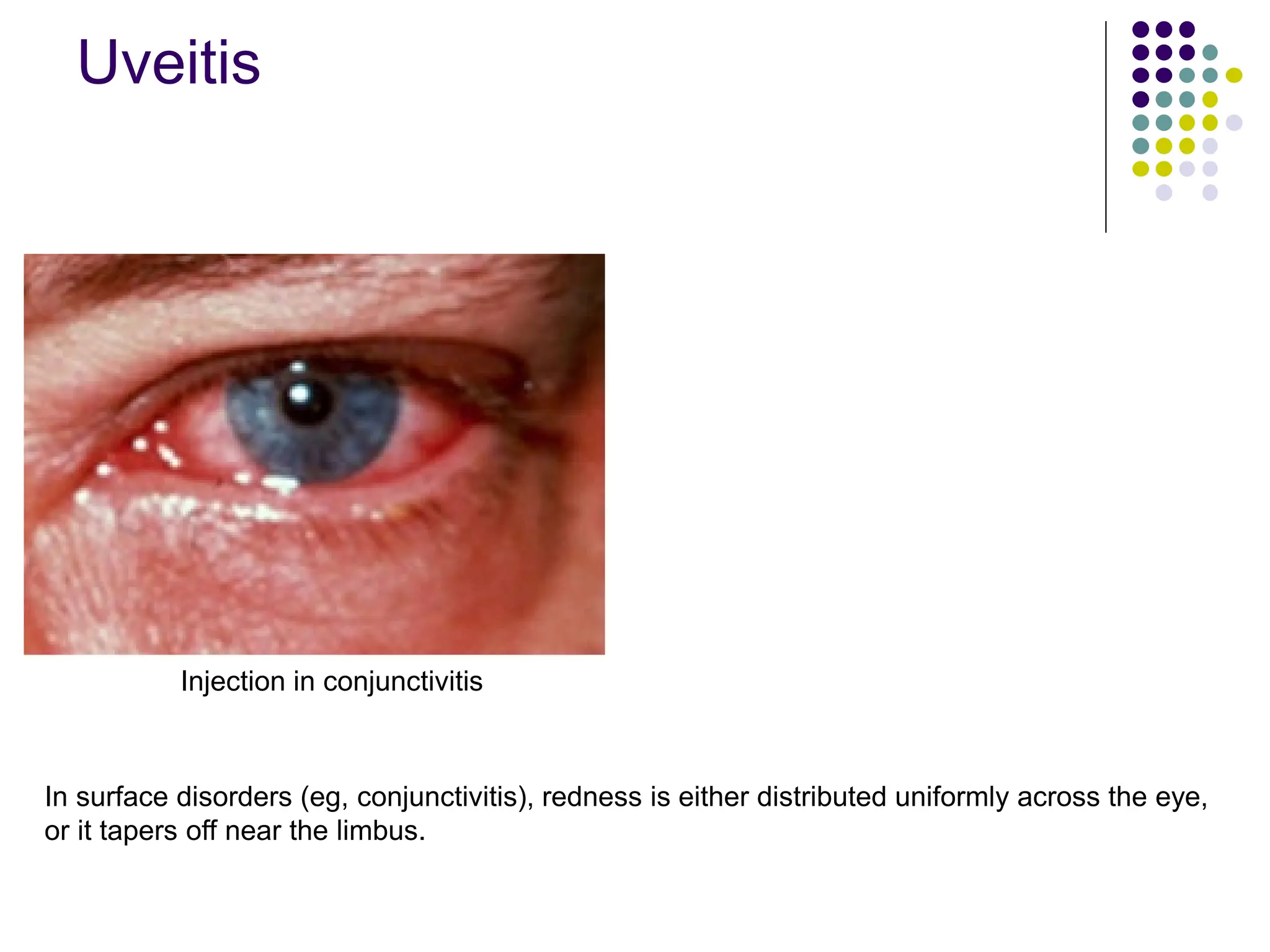 Uveitis in the eye anterior uvitis and posterior uveitis | PDF